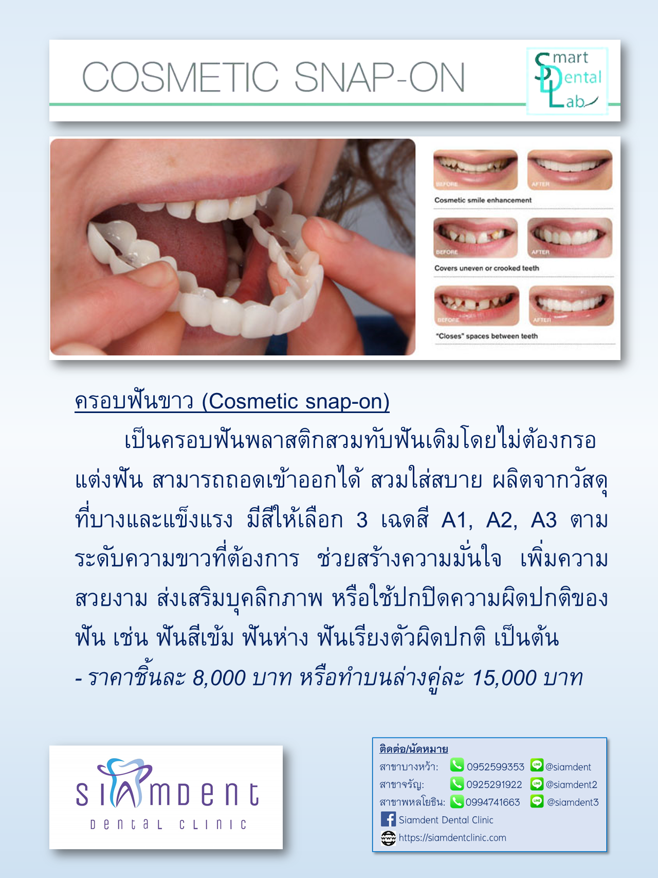 ครอบฟันขาว (Cosmetic snap-on) - Siamdent Dental Clinic