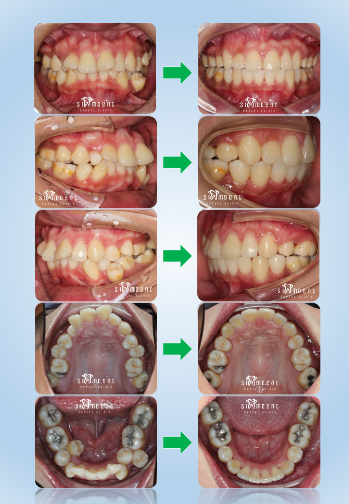 Sample Cases - Siamdent Dental Clinic