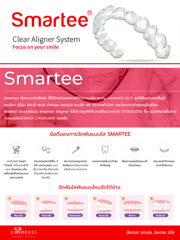 โปรโมชั่นจัดฟันใส Smartee - Siamdent Dental Clinic